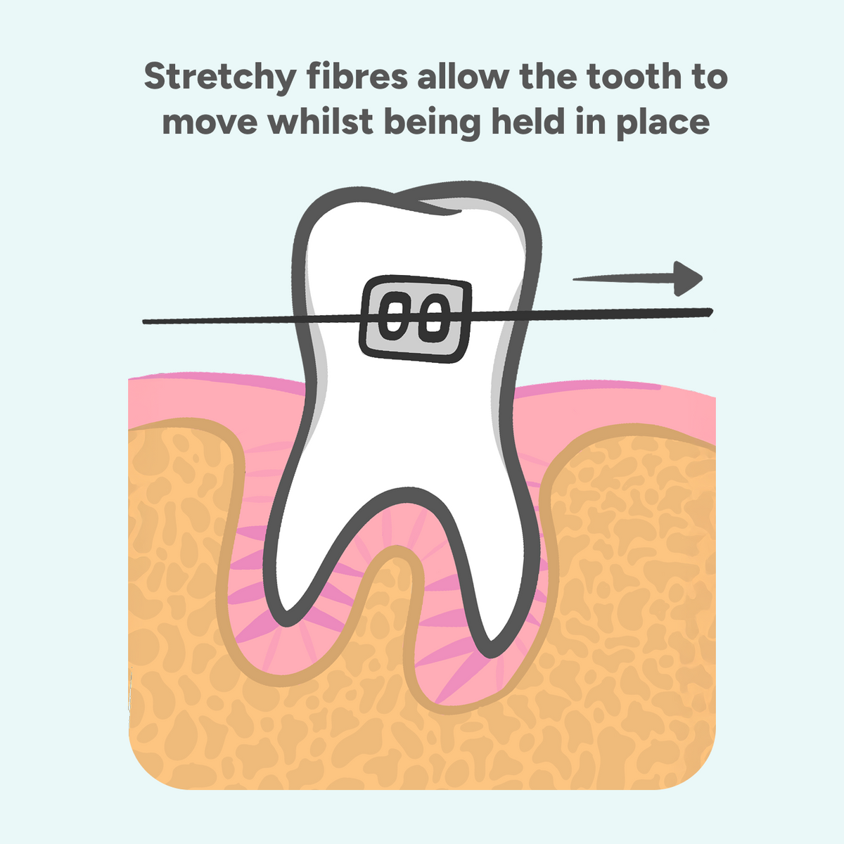 Moving Teeth with Fixed Braces | Healthy Smile Pharmacy